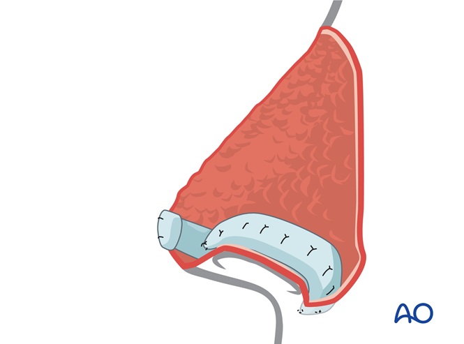 Three stage forehead flap for Large partial thickness defect
