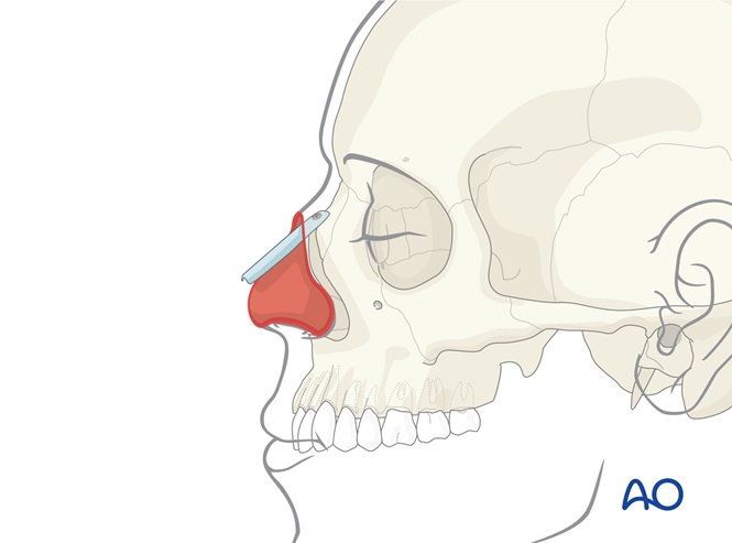 Three stage forehead flap for Large partial thickness defect