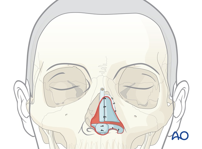 Three stage forehead flap for Large partial thickness defect