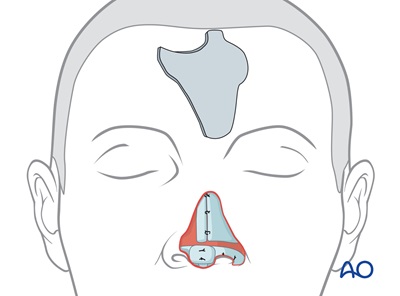 Three stage forehead flap for Large partial thickness defect