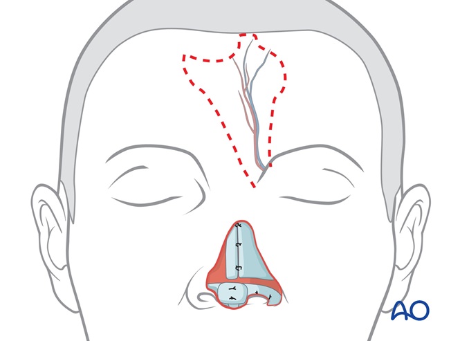 Three stage forehead flap for Large partial thickness defect
