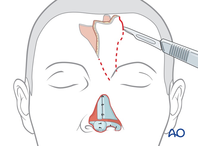 Three stage forehead flap for Large partial thickness defect