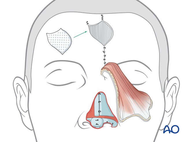 Three stage forehead flap for Large partial thickness defect