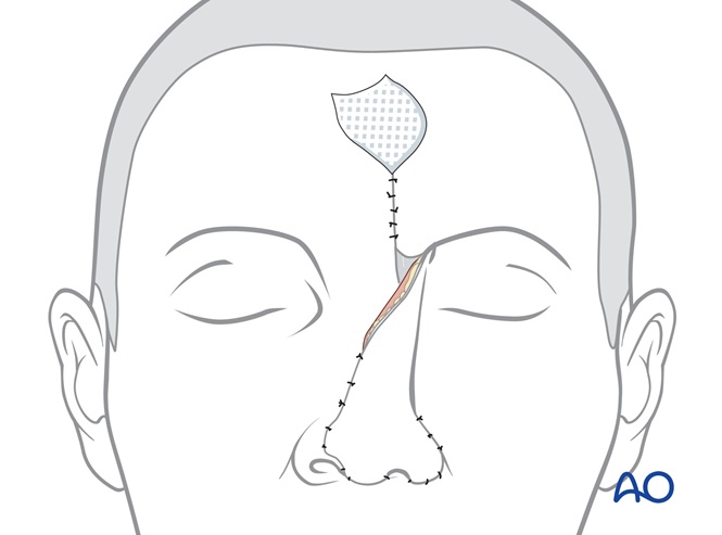 Three stage forehead flap for Large partial thickness defect