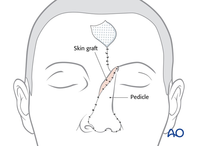 Three stage forehead flap for Large partial thickness defect
