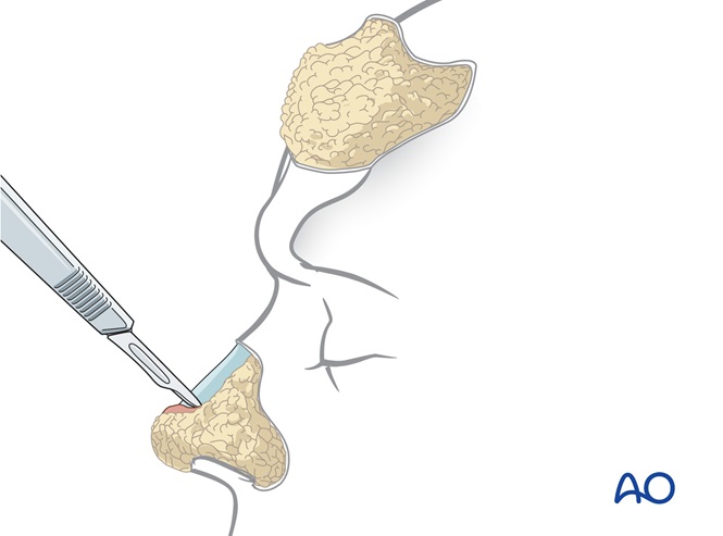 Three stage forehead flap for Large partial thickness defect