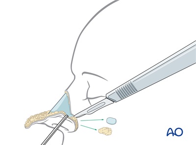 Three stage forehead flap for Large partial thickness defect