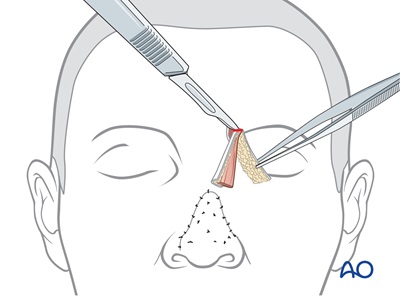 Three stage forehead flap for Large partial thickness defect