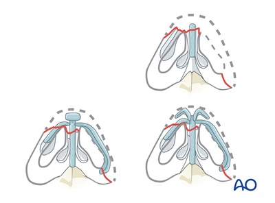 Three stage forehead folded flap for Full thickness defects