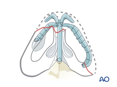 Three stage forehead folded flap for Full thickness defects