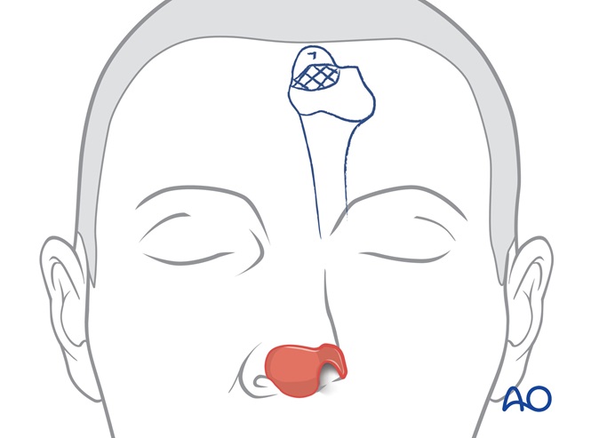 Three stage forehead folded flap for Full thickness defects