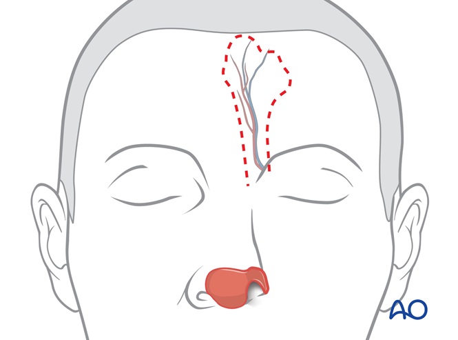 Three stage forehead folded flap for Full thickness defects