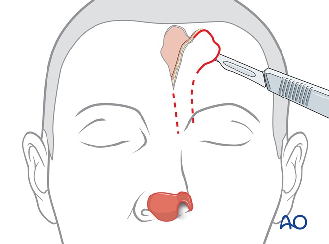 Three stage forehead folded flap for Full thickness defects