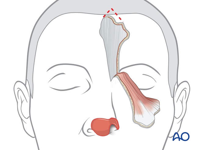 Three stage forehead folded flap for Full thickness defects
