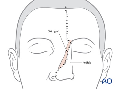 Three stage forehead folded flap for Full thickness defects