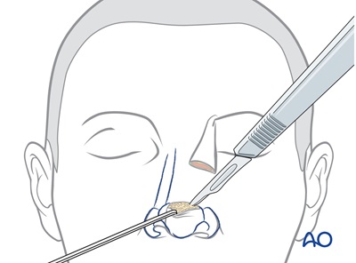 Three stage forehead folded flap for Full thickness defects