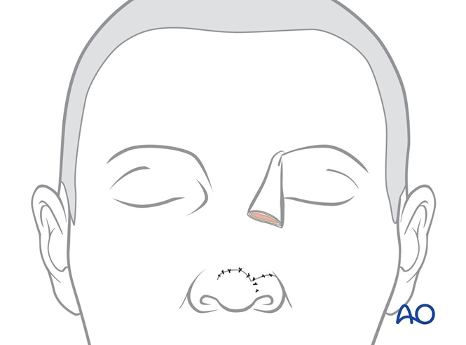 Three stage forehead folded flap for Full thickness defects