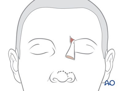 Three stage forehead folded flap for Full thickness defects