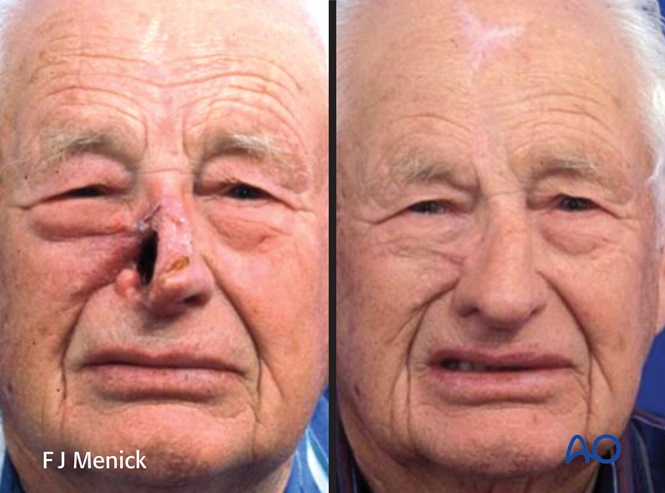 Three stage forehead folded flap for Full thickness defects