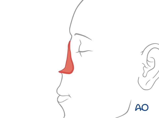 Four stage forehead flap with radial forearm flap for lining for Full ...