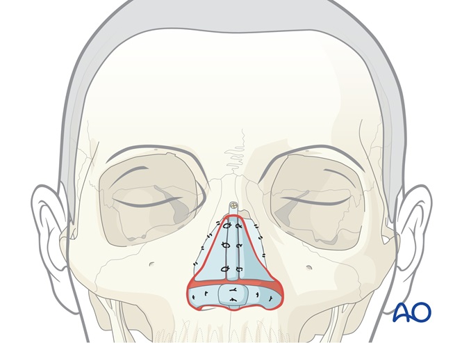 Four stage forehead flap with radial forearm flap for lining for Full ...