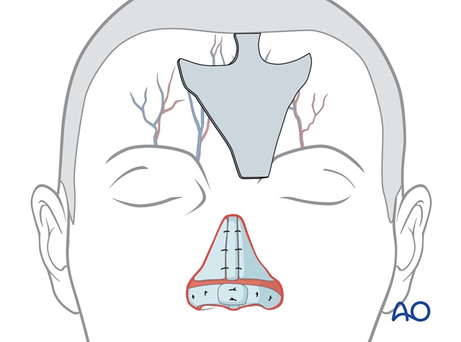 Four stage forehead flap with radial forearm flap for lining for Full ...