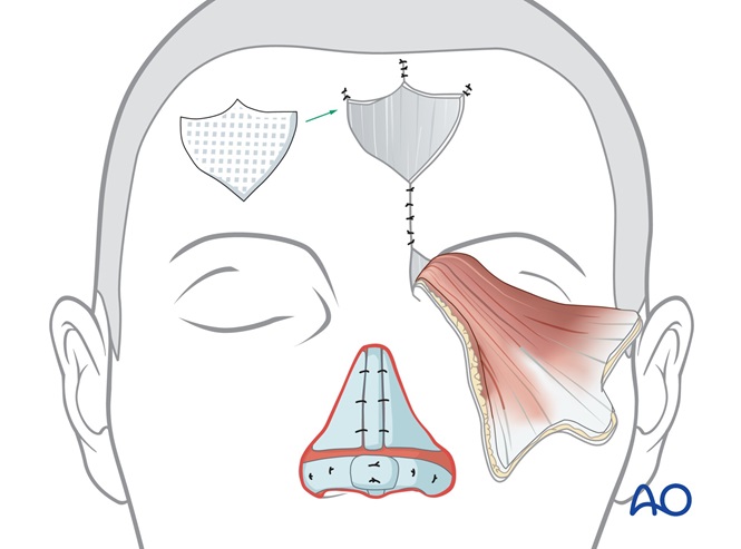 Four stage forehead flap with radial forearm flap for lining for Full ...