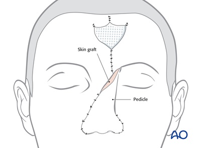 Four stage forehead flap with radial forearm flap for lining for Full ...