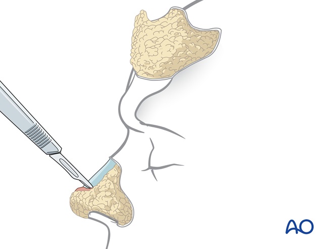 Four stage forehead flap with radial forearm flap for lining for Full ...