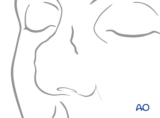 One stage nasolabial flap for Small superficial defect