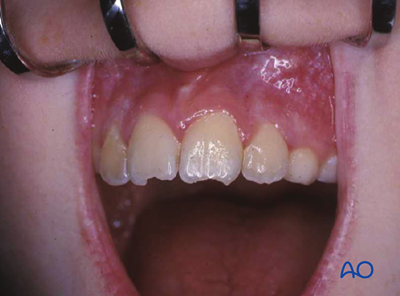 Tooth fracture, enamel only/dentin exposure