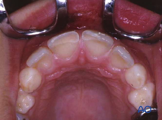 Tooth fracture, enamel only/dentin exposure