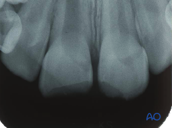 Tooth fracture, enamel only/dentin exposure