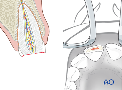 Pulp capping / partial amputation / extirpation for Tooth fracture ...