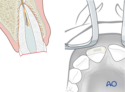 Pulp capping / partial amputation / extirpation for Tooth fracture ...