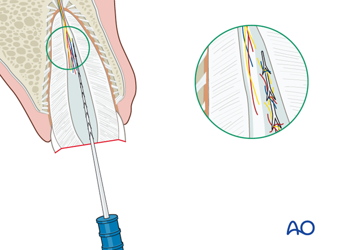 Pulp capping / partial amputation / extirpation for Tooth fracture ...