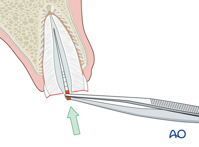 Pulp capping / partial amputation / extirpation for Tooth fracture ...