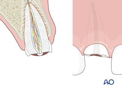 Pulp capping / partial amputation / extirpation for Tooth fracture ...
