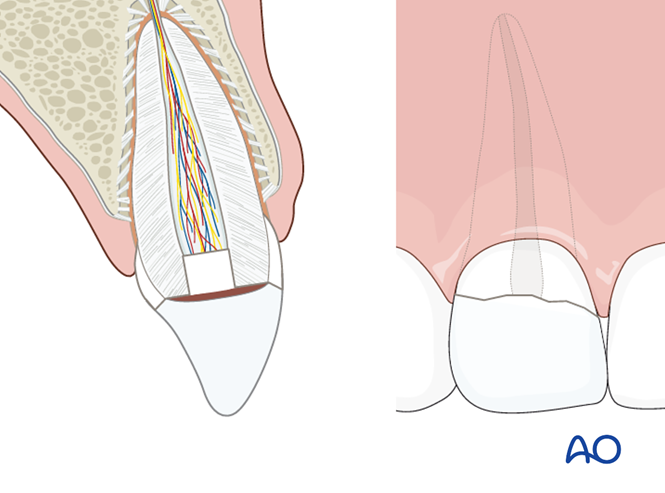 Pulp capping / partial amputation / extirpation for Tooth fracture ...