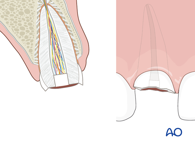 Pulp capping / partial amputation / extirpation for Tooth fracture ...