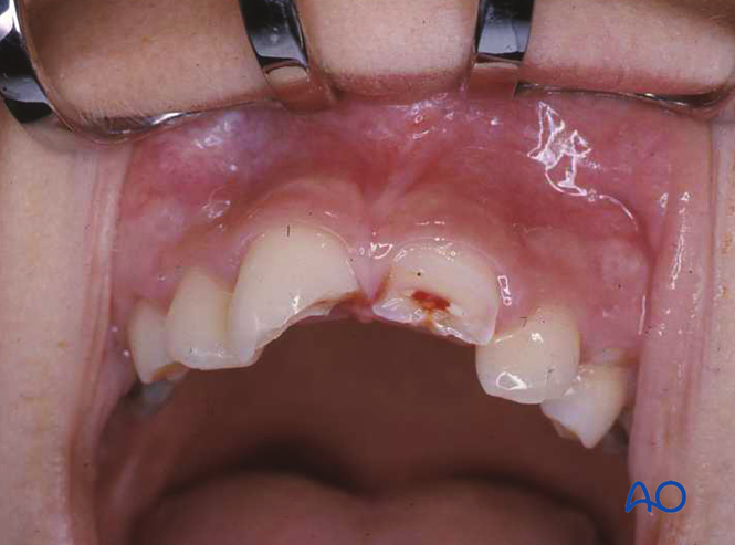 Tooth fracture, pulp exposure