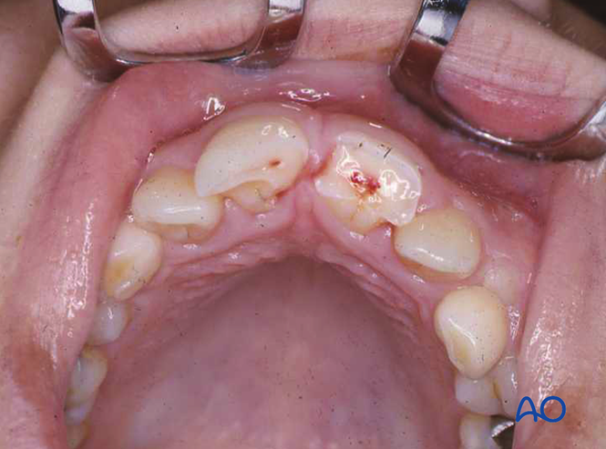 Tooth fracture, pulp exposure