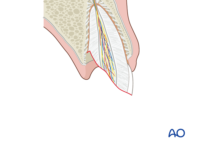 Tooth fracture, crown-root fracture