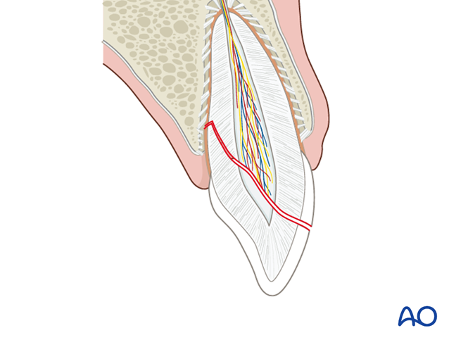 Various treatment options for Tooth fracture, crown-root fracture