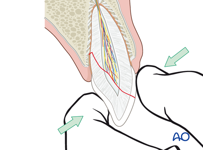 Various treatment options for Tooth fracture, crown-root fracture