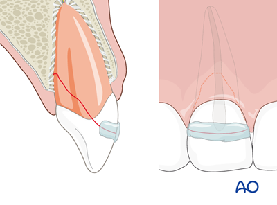 Various treatment options for Tooth fracture, crown-root fracture