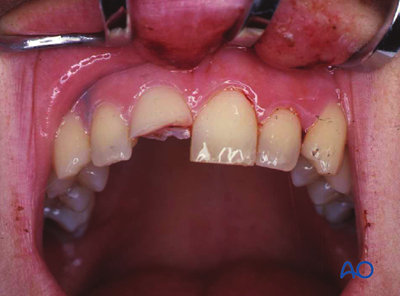 Tooth fracture, crown-root fracture