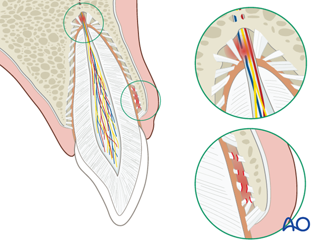 Tooth subluxation, without displacement - Subluxation