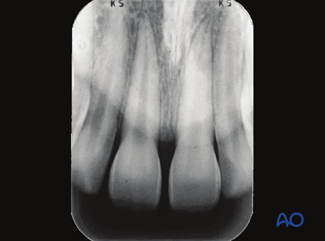 Tooth subluxation, without displacement - Subluxation