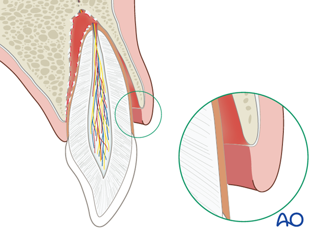 Tooth luxation with displacement - Extrusion